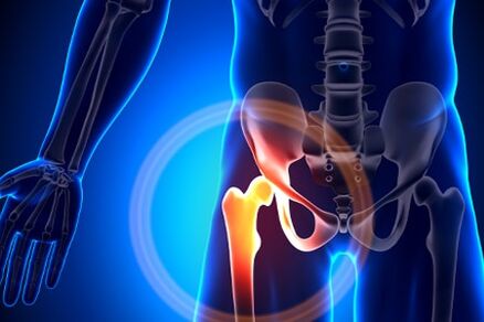 Artróza kyčelního kloubu: příčiny, příznaky, stupně, léčba, operace - Depanten